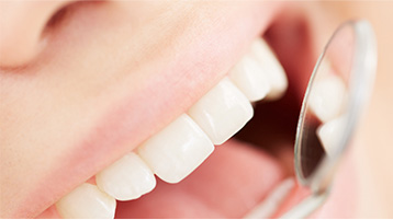 bright-teeth - Bedminster Orthodontics